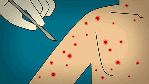 Variolation smallpox GIF on GIFER - by Adrielak