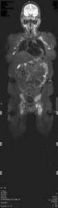 Mri diagnosis lymphoma GIF - Find on GIFER