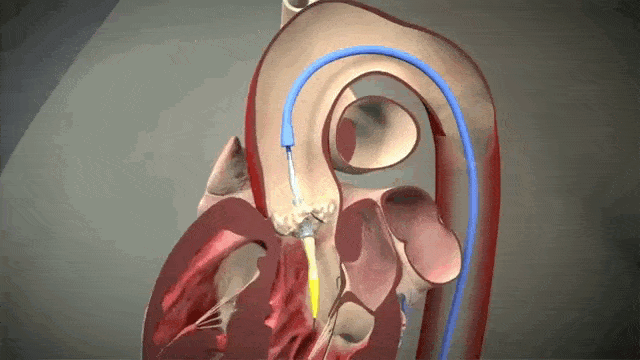 GIF valve - animated GIF on GIFER