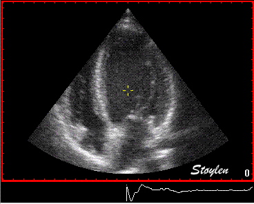 Echocardiography ultrasound line GIF - Find on GIFER