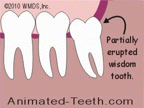 Wisdom teeth GIF - Find on GIFER