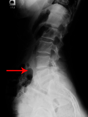GIF spine atlanta surgery - animated GIF on GIFER