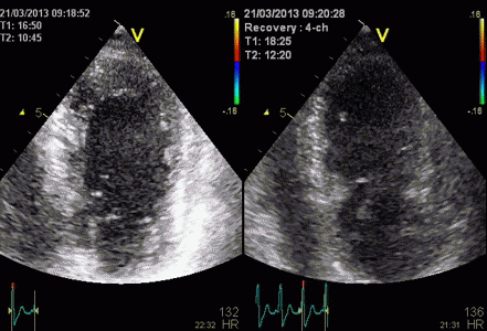 Echocardiography ultrasound doppler GIF - Find on GIFER