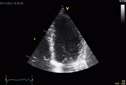 Echocardiography line GIF - Find on GIFER