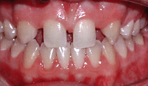 Teeth GIF - Find on GIFER