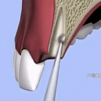 Implant GIFs - Get the best gif on GIFER