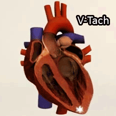 Ventricular tachycardia GIFs - Obtenez le meilleur gif sur GIFER