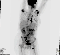 Lymphoma GIFs - Get the best gif on GIFER