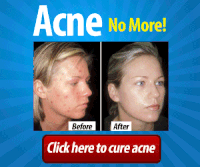 Acne GIFs - Get the best gif on GIFER