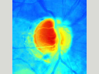 Glaucoma GIF - Conseguir o melhor gif em GIFER