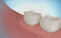 Tooth extraction GIFs - Get the best gif on GIFER