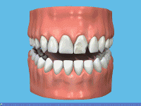 Tooth extraction GIFs - Get the best gif on GIFER