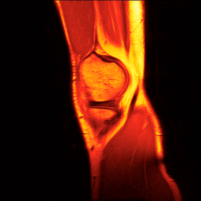 Meniscus GIF - Conseguir o melhor gif em GIFER