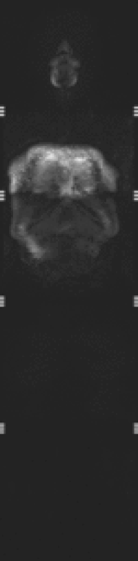 Lymphoma GIFs - Get the best gif on GIFER